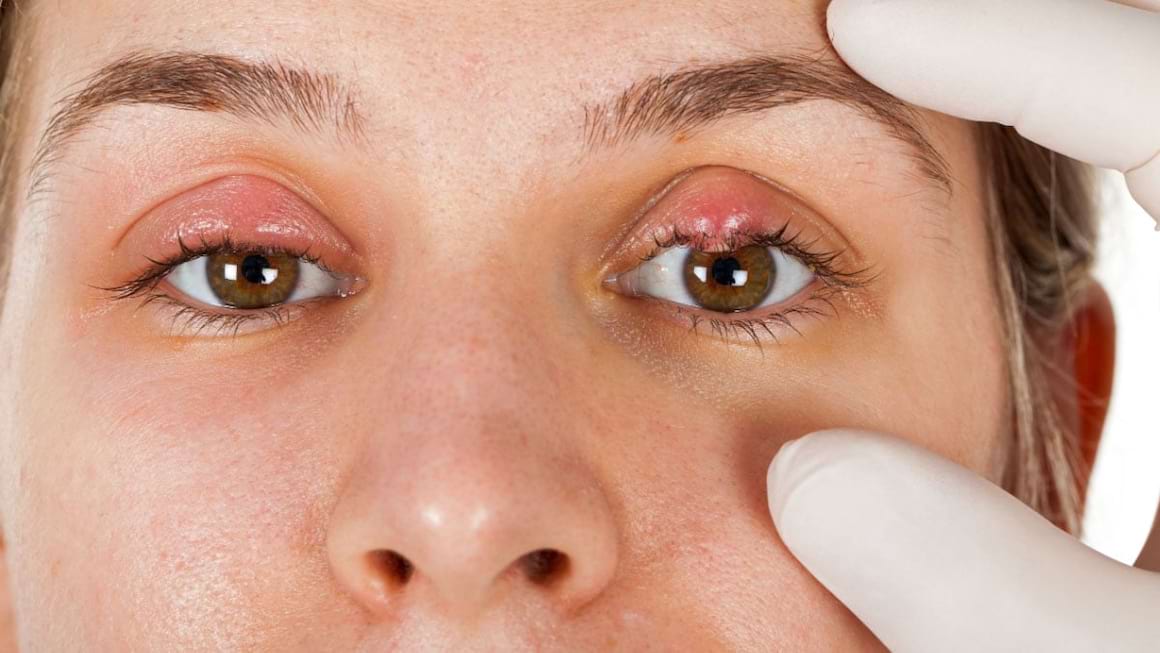 Orjeletul (ulciorul / urciorul)