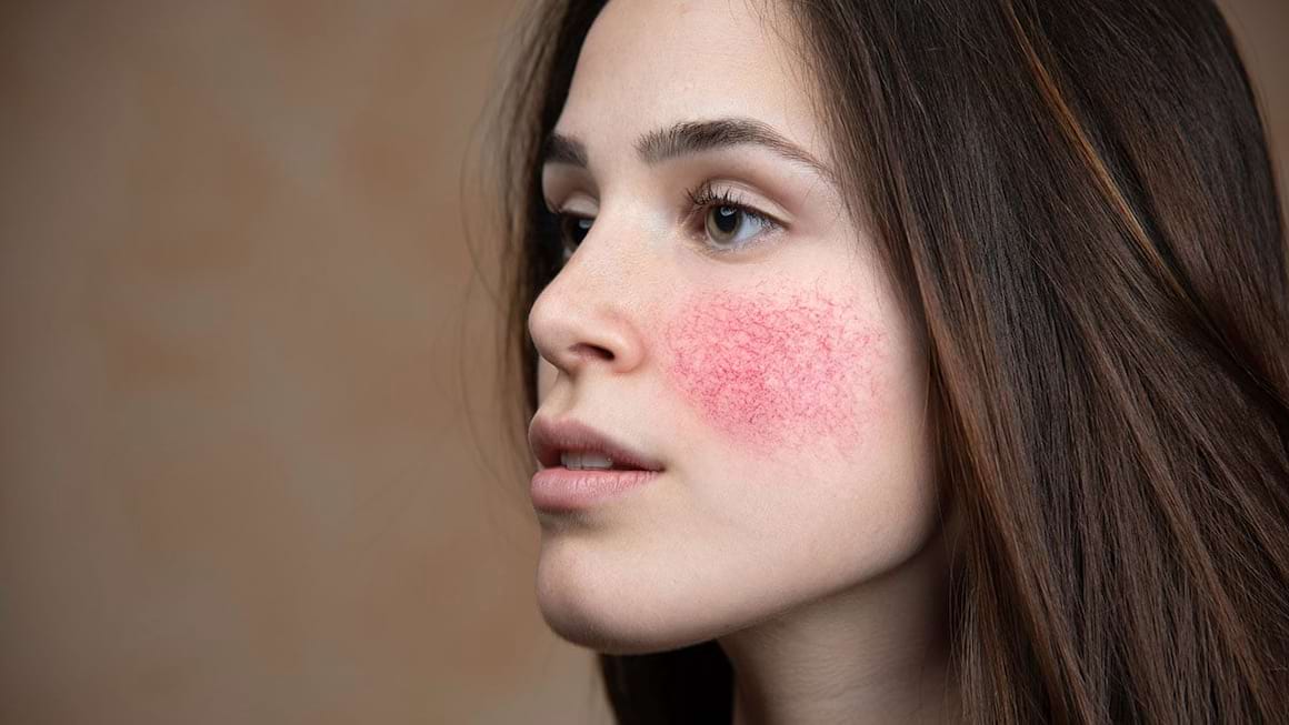 Rozaceea – cauze, manifestări şi metode de tratament