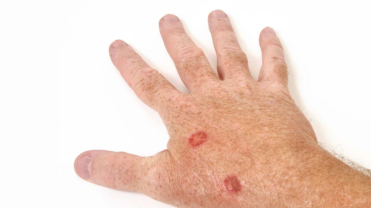 Ce este keratoza actinică și cum arată?