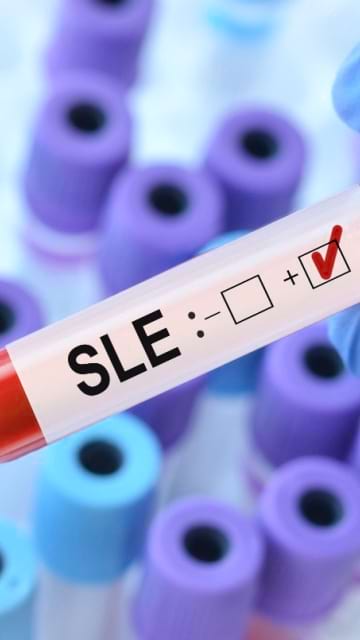 Principii de diagnostic in lupusul eritematos sistemic