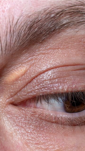 Xantoamele: cauze, diagnostic si tratament