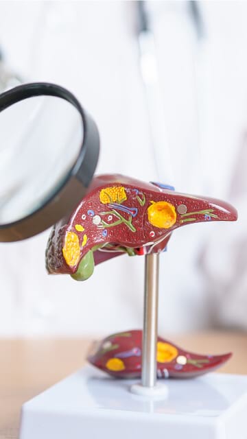 Necroza cailor biliare