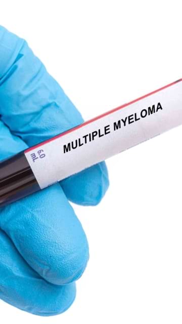 Recidiva în mielom multiplu