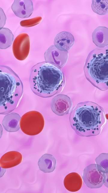 Tipuri de leucemie si diferentele dintre acestea