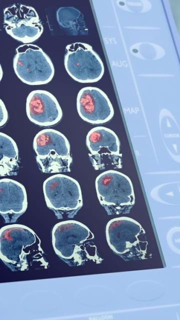 Tratamentul general al accidentului vascular cerebral (AVC)