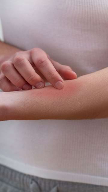 Mușcături de insecte pe care nu trebuie să le ignori