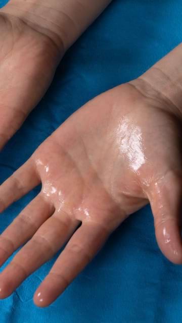 Hiperhidroza palmara si plantara – remedii pentru transpiratia excesiva