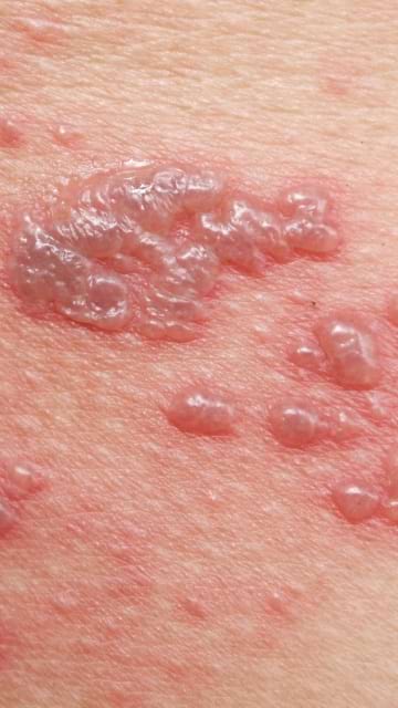 Bășici pe piele: de ce apar și cum scăpăm de ele?