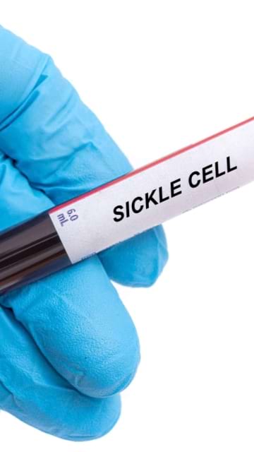 Totul despre siclemie